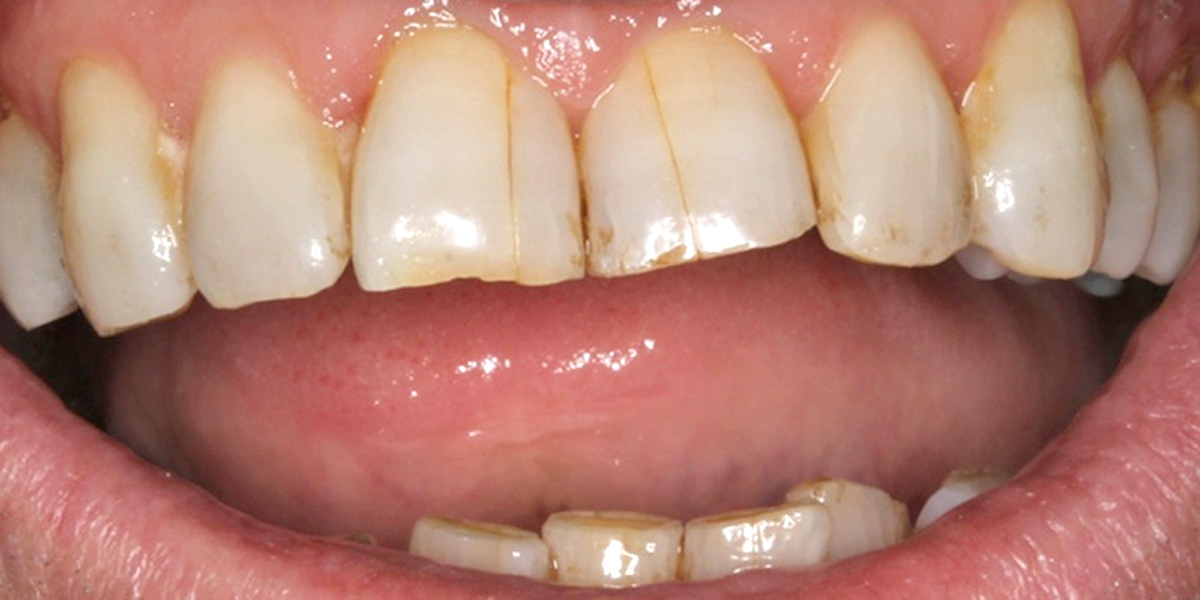 TRAUMA ZUBA - STOMATOLOŠKA ORDINACIJA ČEOVIĆ